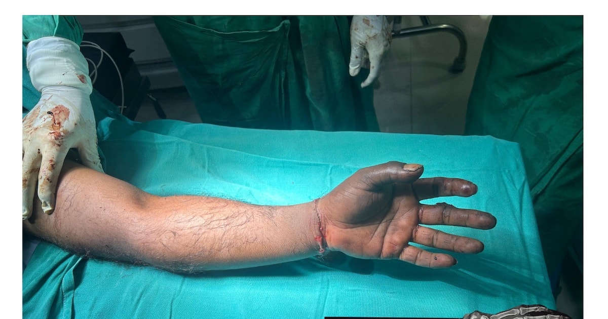 surji hospital doctors successfully reattached the severed hand